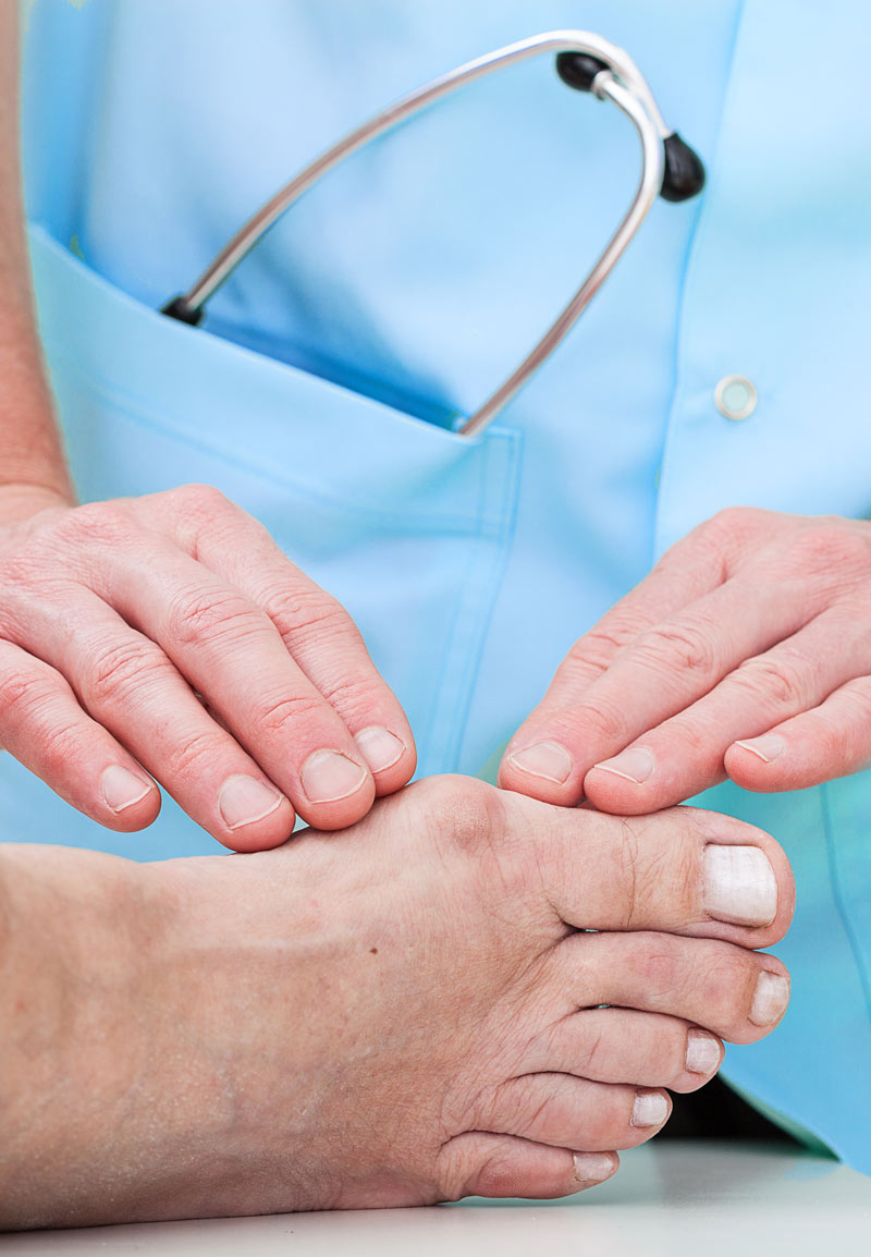 Bunion Surgery Mukwonago | Menomonee Falls Foot & Bunion Specialist