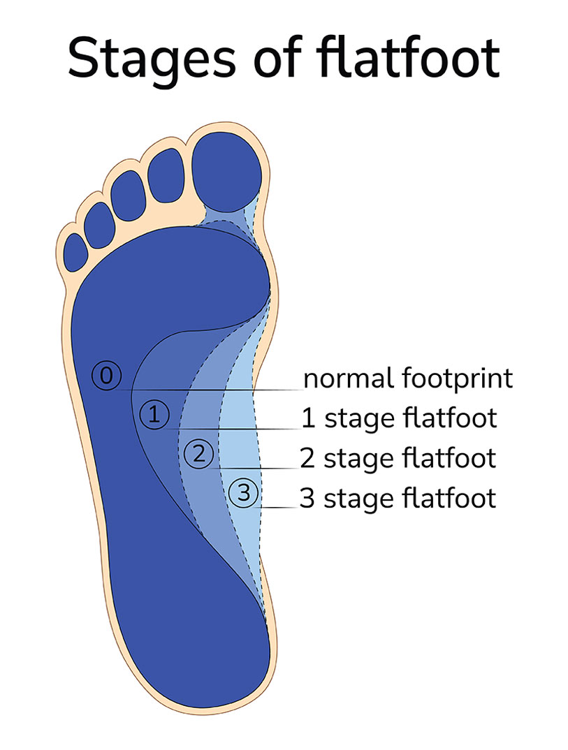 Flatfoot Treatment Brookfield | Hartland WI Fallen Arches Foot Doctor