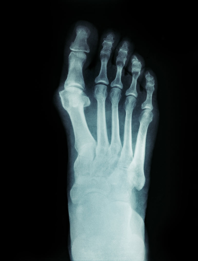 Hallux Rigidus Symptoms Watertown | Pain in Big Toe Pewaukee, WI
