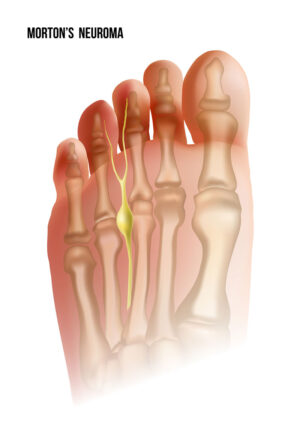Neuroma Symptoms & Treatment Hartland | Doctor Toe Pain Menomonee
